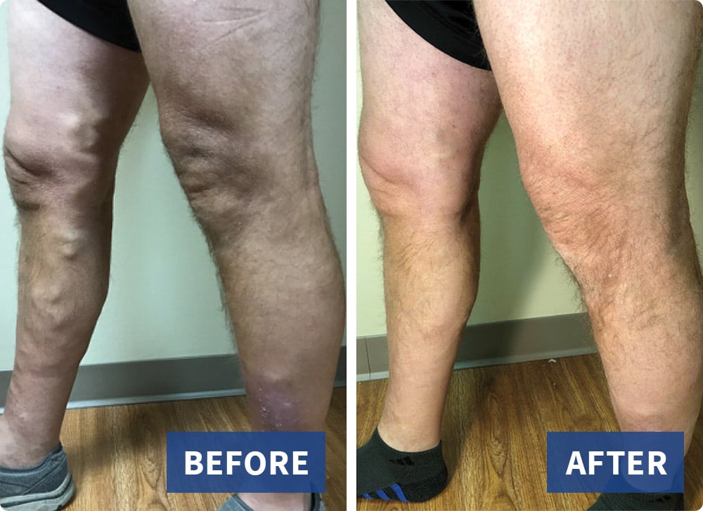 Symtoms | Vein Disease | Center for Vein Restoration