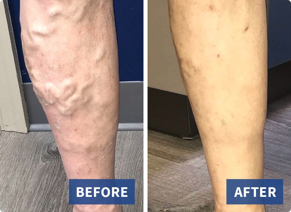 Treatment | Vein Disease | Center for Vein Restoration