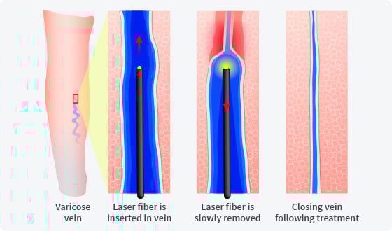 Treatment | Vein Disease | Center for Vein Restoration