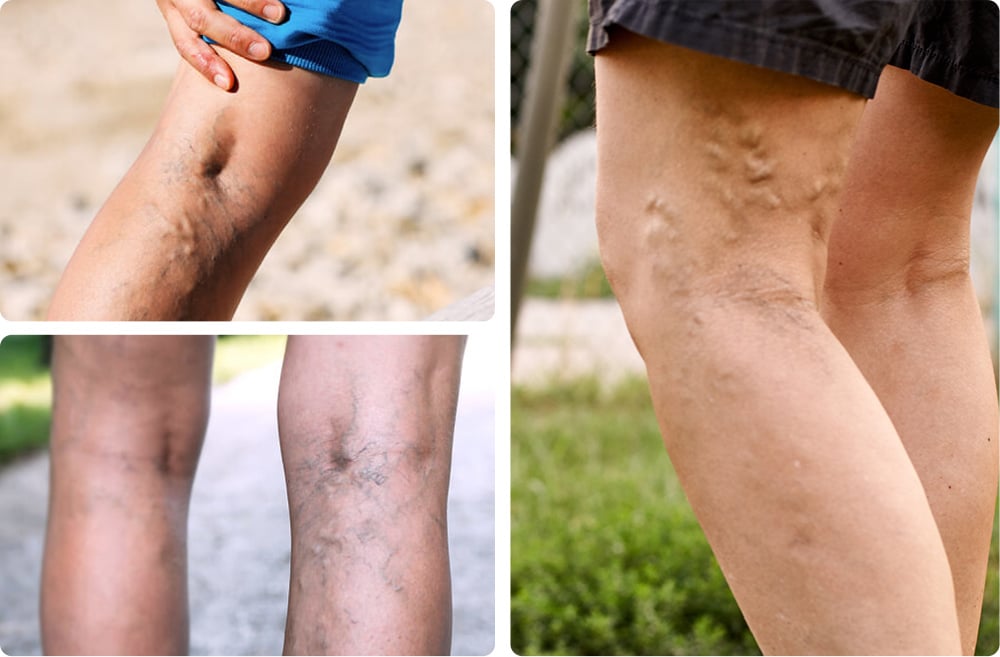 Symtoms | Vein Disease | Center for Vein Restoration