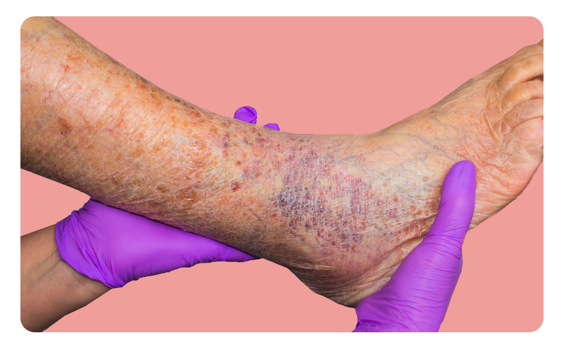 DVT | Vein Disease | Center for Vein Restoration